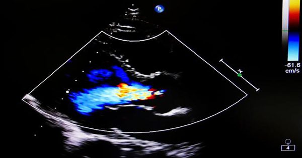 COMMENT RÉALISER UNE ÉCHOGRAPHIE PULMONAIRE CHEZ LE PATIENT INSUFFISANT ...